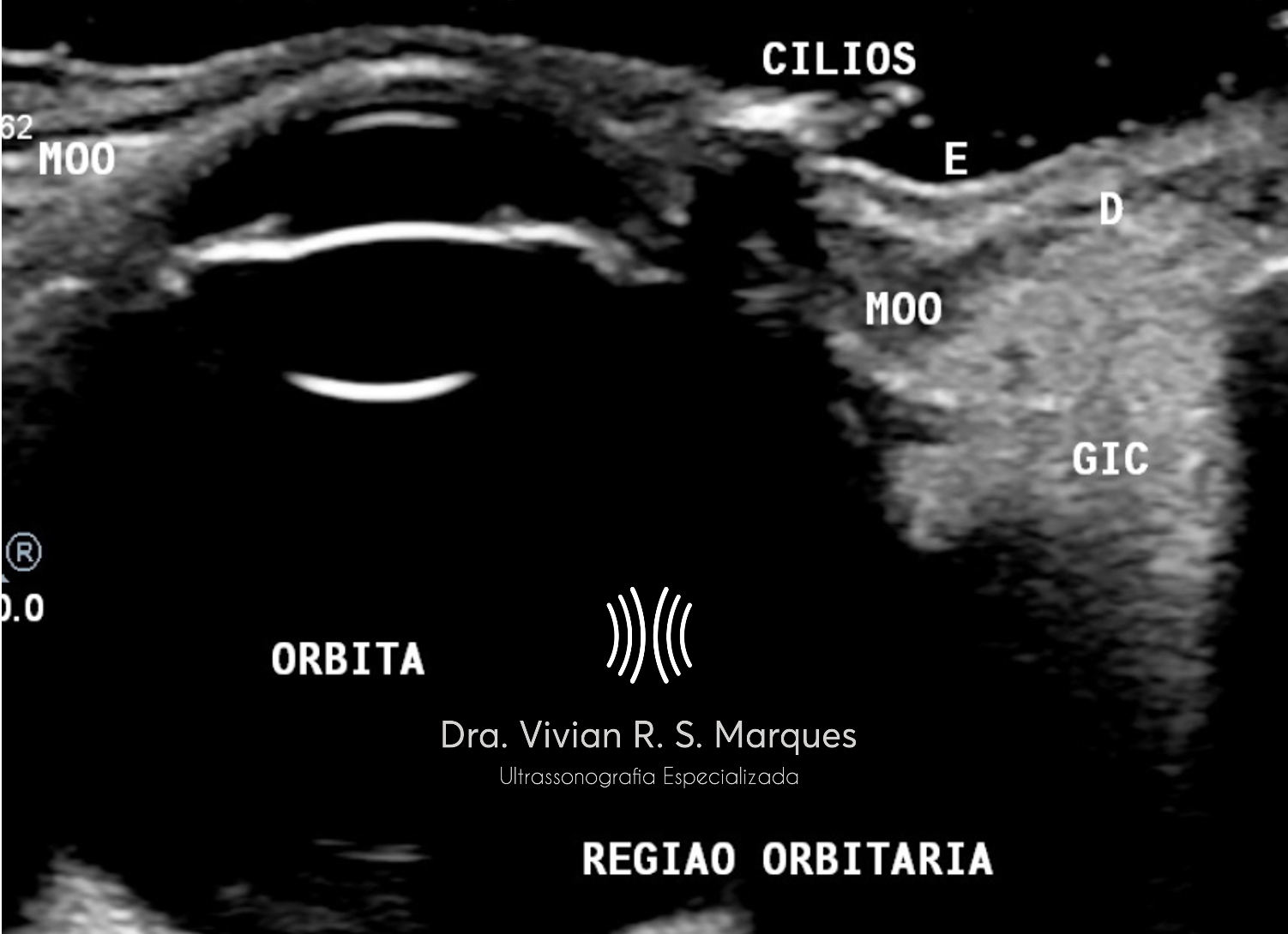 Conheça Mais Sobre a Ultrassonografia Dermatológica - Dra Vivian