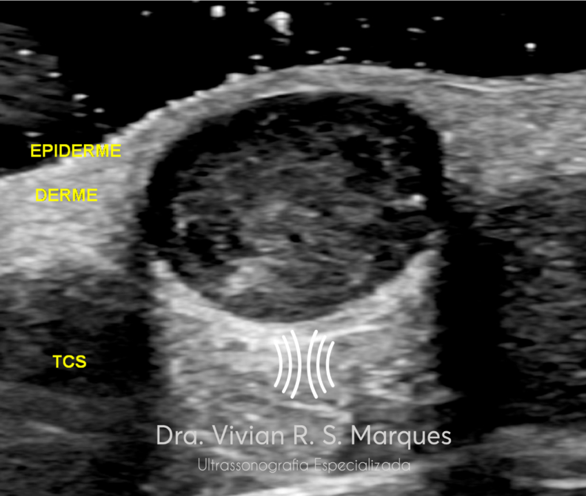 Cistos Epidérmicos: o que você precisa saber? - Dra Vivian